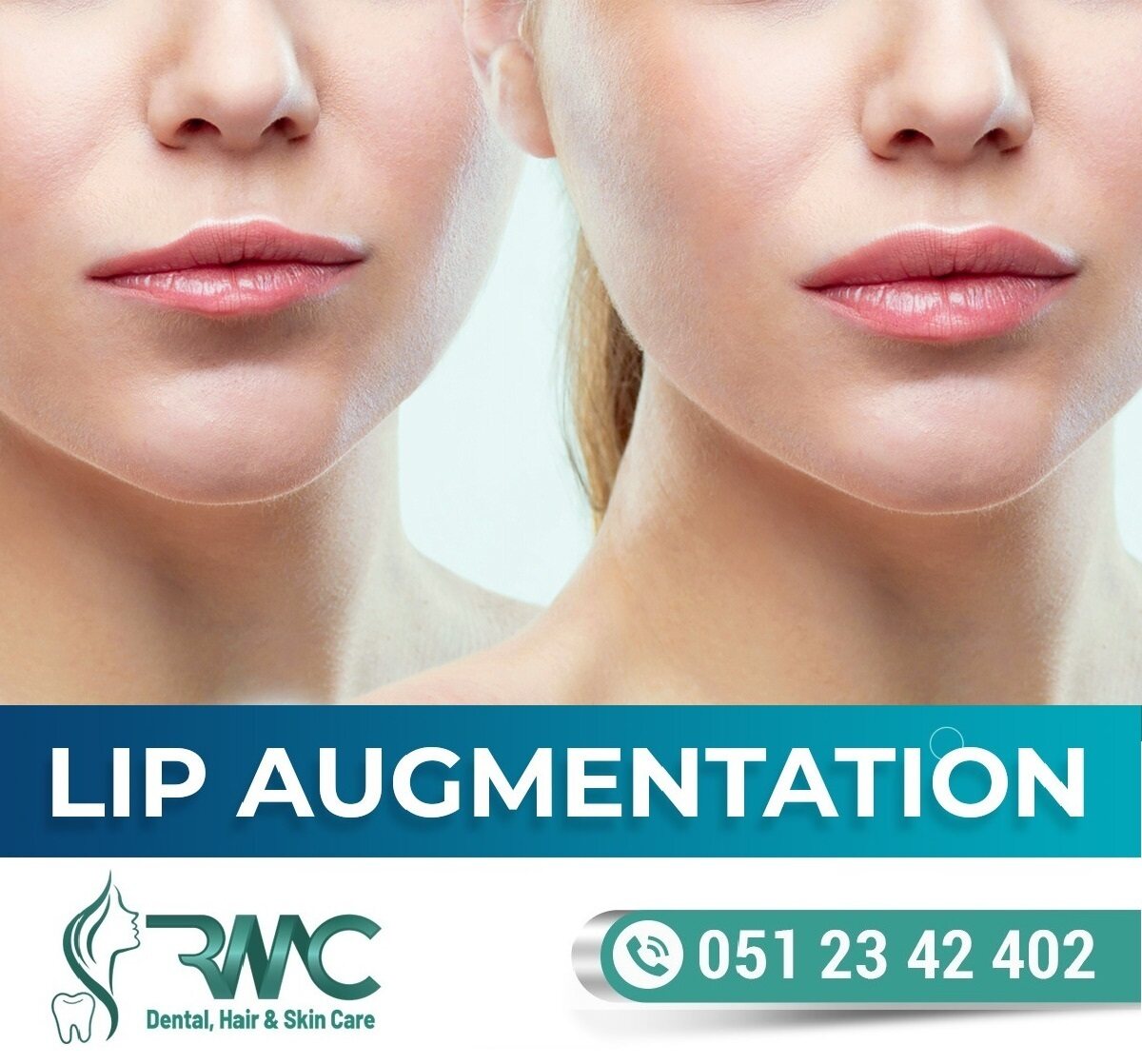 Lip Filler Treatment in Islamabad, Injections -Rehman Medical Center